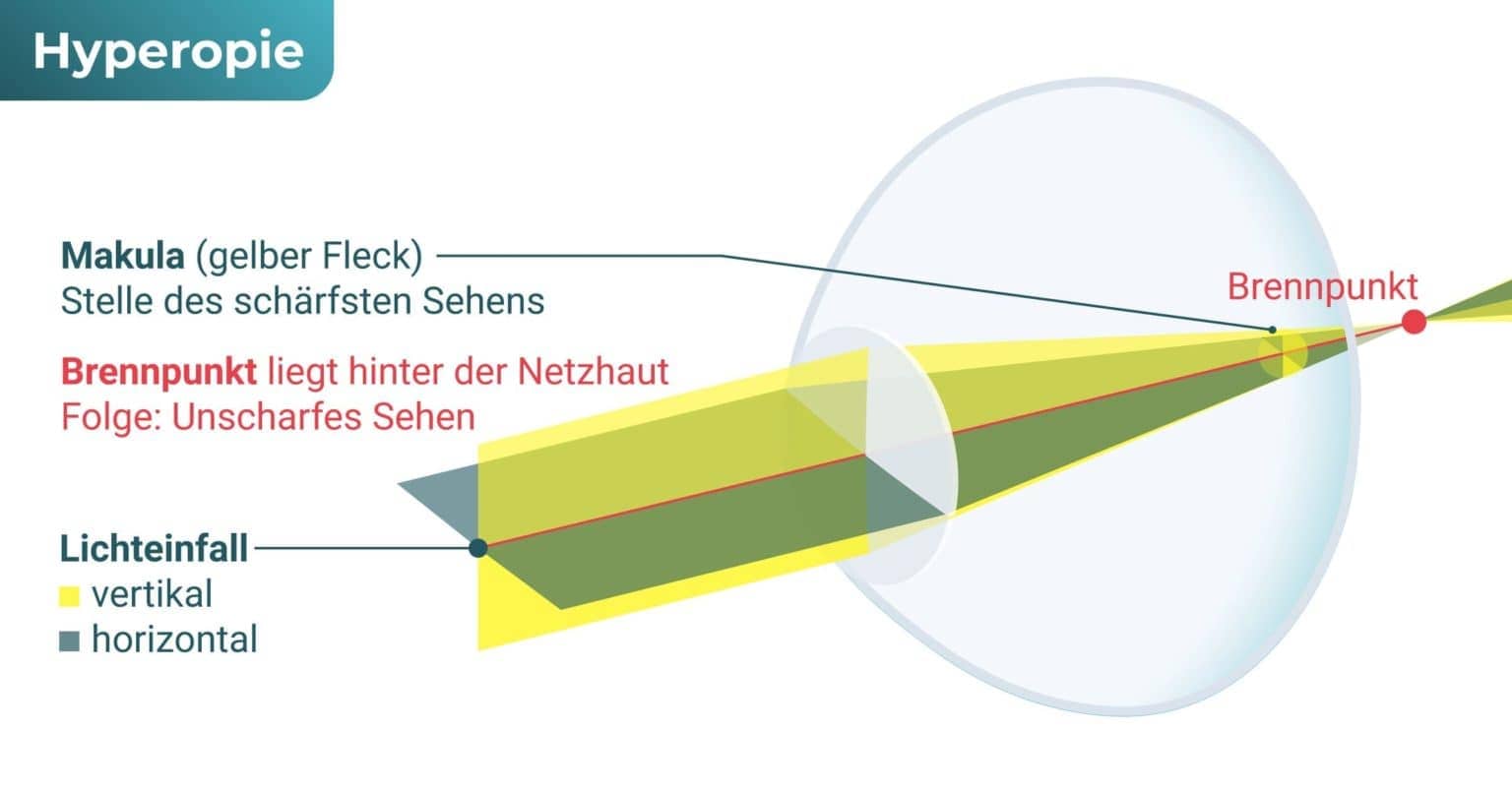 Weitsichtigkeit (Hyperopie) – Alle wichtigen Infos